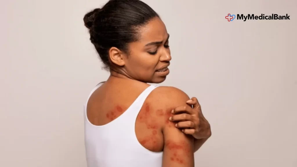 How to Treat Eczema, Rashes, and Skin Infections at Home ...